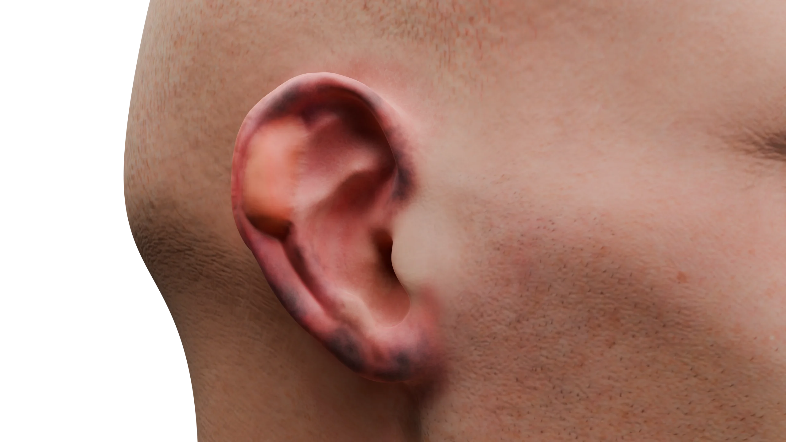 Trauma to the external ear: classification, causes, symptoms, diagnosis and treatment